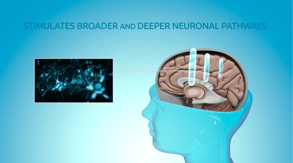 Deep TMS™ vs TMS: What Is the Difference? | BrainsWay