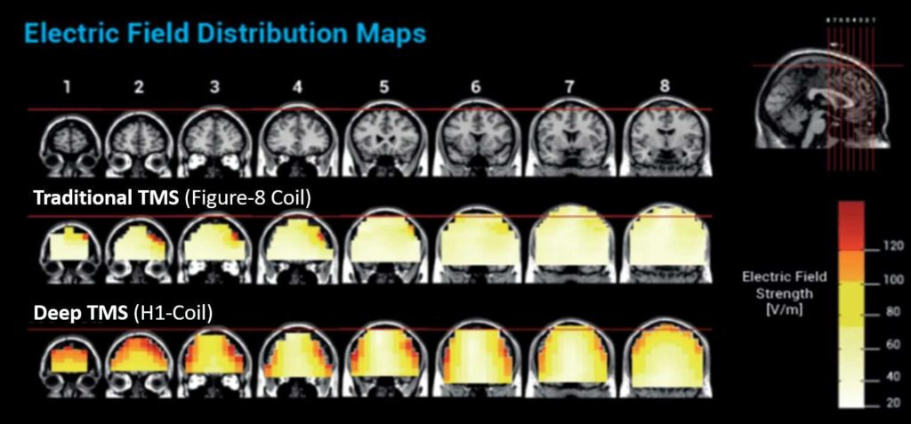 Deep TMS™ vs TMS: What Is the Difference? | BrainsWay